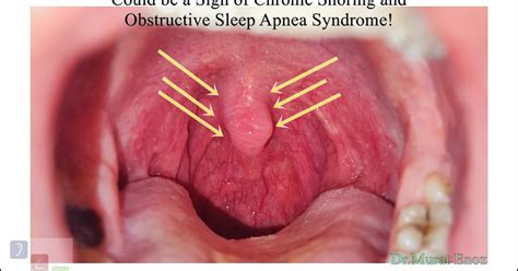 Your Uvula Can Tell You A Lot About Whether You Have Snoring And