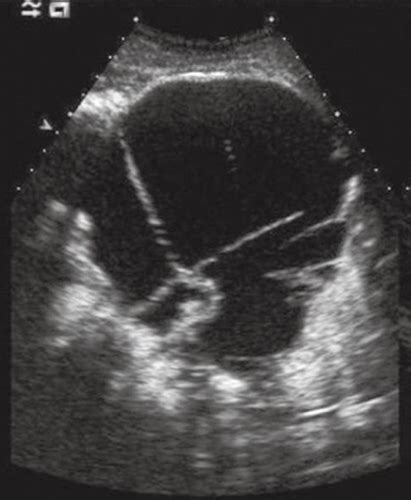 Pancreas Pathology Flashcards Quizlet