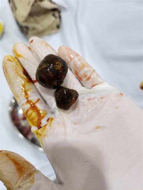 Wifes Gallstone Rgallbladders