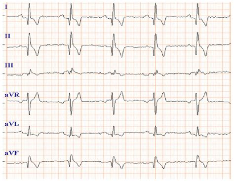 Sinus Rhythm Prolonged P Waves And Qrs Complexes Suggesting