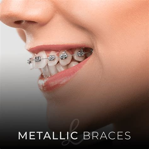 The Different Types Of Orthodontic Braces Which Type Is Right For You