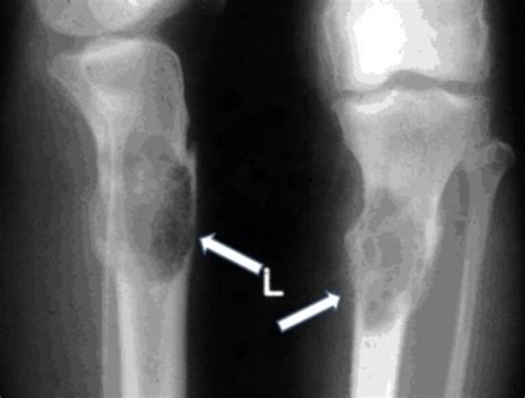 Hyperparathyroidism Concise Medical Knowledge