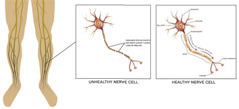 Neuropathy Information Select Health Of The Carolinas