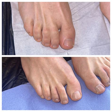 Webbed Toes Syndactyly Treatment