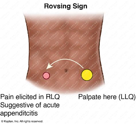 Rovsing Sign