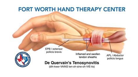 De Quervains Tenosynovitis