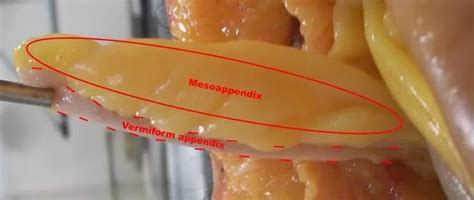 La Posición Anatómica Del Apéndice Vermiforme Y Su Morfometría
