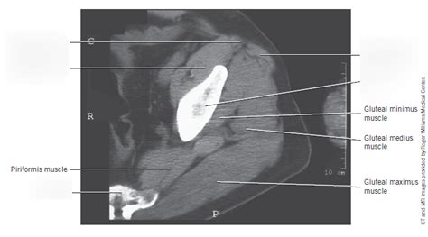 Diagram Of Ct Hip 1 Quizlet