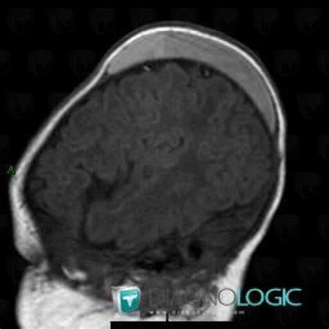 Radiology Case Cephalohematoma Mri Diagnologic
