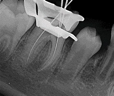 Revista Canal Abierto Regenerative Endodontic Procedure In Young