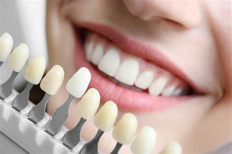 Can You Whiten Crowned Teeth Understanding Your Options