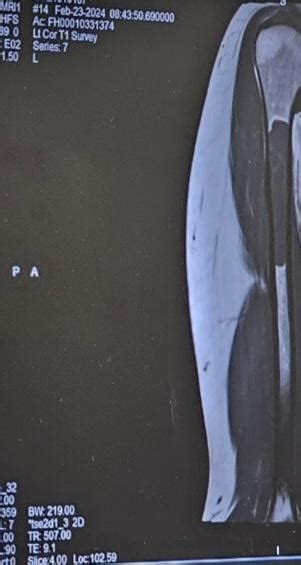 Left Humerus Mri R Radiology