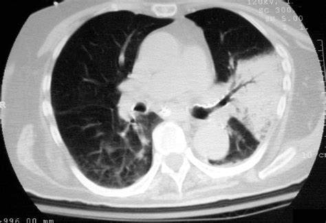 Air Bronchogram Finding The Common Vein