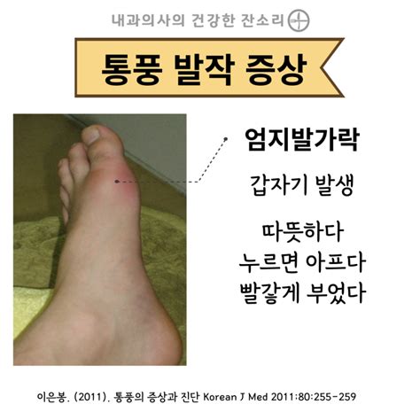 통풍의 증상과 원인 통풍에 좋은 음식 A17