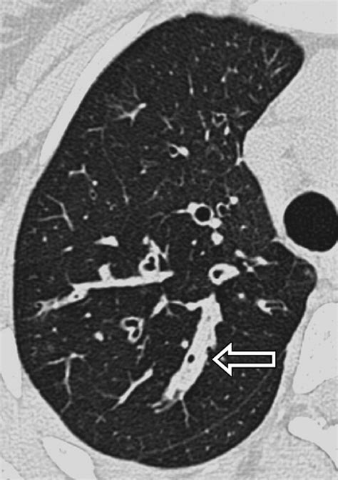 Pulmonary Hyperlucency In Adults Ajr
