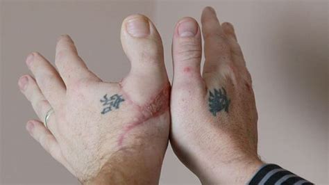 This Man Had His Thumb Replaced By His Toe