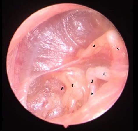 Retracted Tympanic Membrane