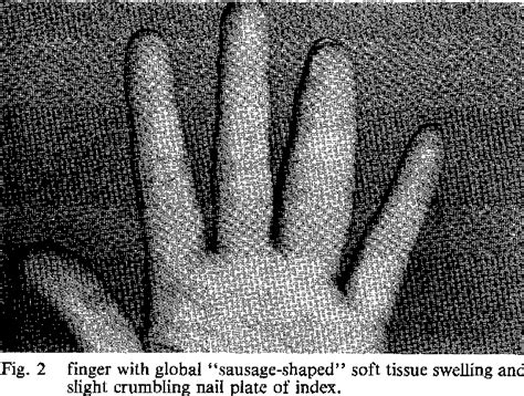 Figure 1 From Differential Diagnosis Of Acute Dactylitis Psoriatica Semantic Scholar