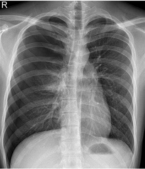 Image Shows 50 Pneumothorax Of Right Lung Download Scientific Diagram