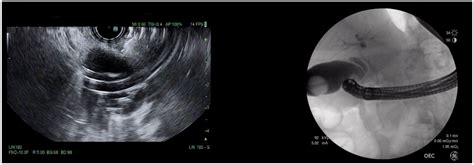 Endoscopic Ultrasound Guided Gallbladder Drainage In Patients With