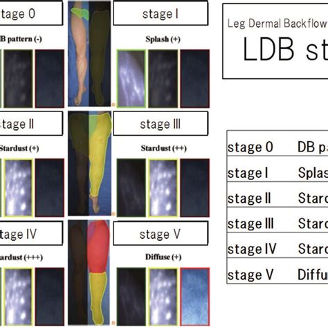 Characteristic ICG Lymphography Findings With Progression Of Download Scientific Diagram