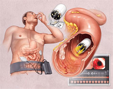 Smarter Capsule For Endoscopy Diagnostics Science Techniz