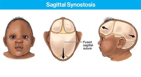 Sagittal Suture Ridge