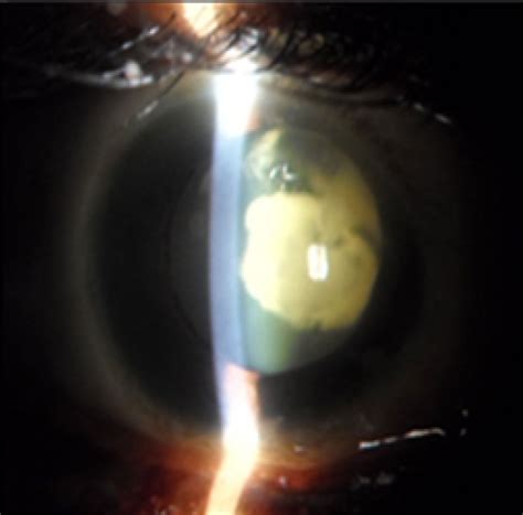 Case 1 Obliterating Cortical And Nuclear Cataract Download