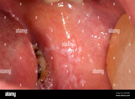 White Spots Inside Lips