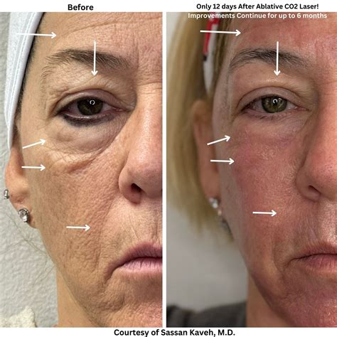 Ablative Laser Resurfacing With Ultrapulse Alpha Co2 Alpha Medical