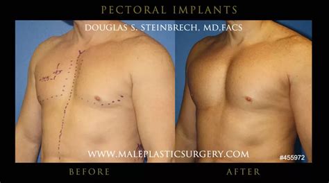 Pec Implants Before And After Photos Male Plastic Surgery