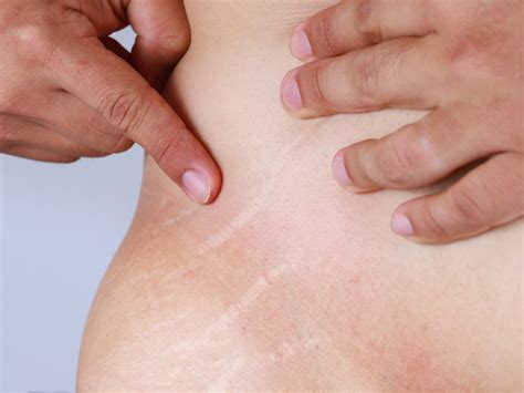 Stretch Mark Correction Transform Your Skin Today — Allure Aesthetics