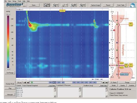Figure 1 From Jejunal Graft Conduits After Esophagectomy Semantic