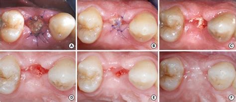What Does A Blood Clot After Tooth Extraction Look Like Understanding