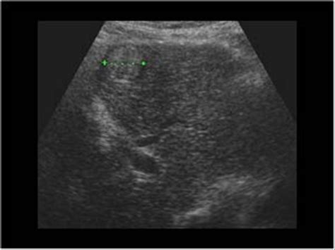 Abdomen And Retroperitoneum 11 Liver Case 117 Hepatocellular