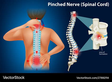 Diagram Showing Pinched Nerve Royalty Free Vector Image