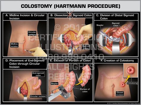 Colostomy Hartmann Procedure