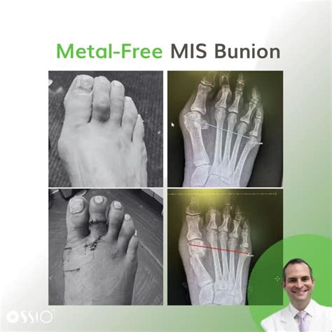 Daniel Popowitzdpmfacfas On Linkedin I Was Asked To Mention My Post Op Course Thick