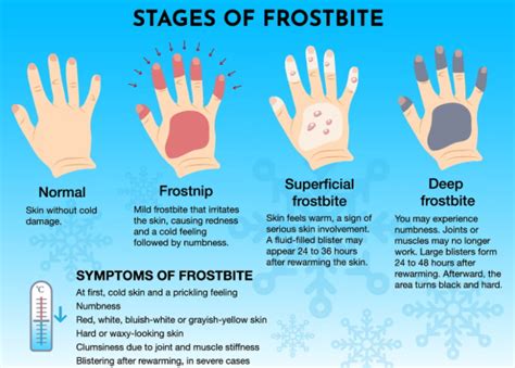 Identifying Frostnip From Frostbite Civic Media