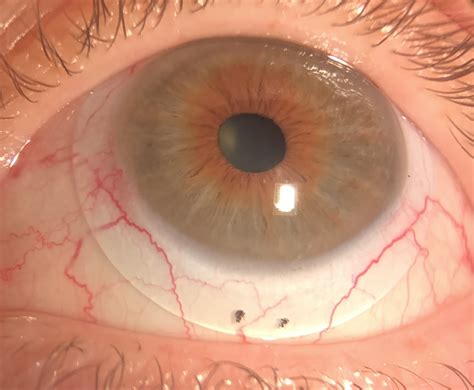 Troubleshooting Scleral Lens Cases For Improved Performance Contact