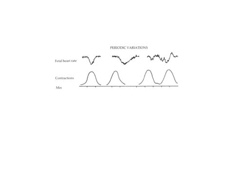 Fetal Decelerations Quiz