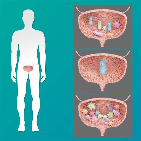 Bacteriuria Asintomática Aeuexp