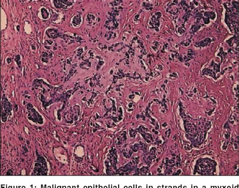 Malignant Chondroid Syringoma