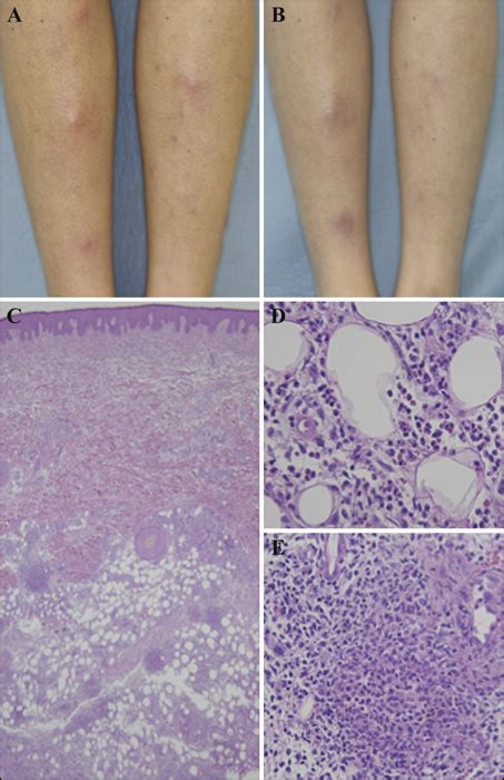 Crohns Disease Noncaseating Granulomas Quotes Trendy New