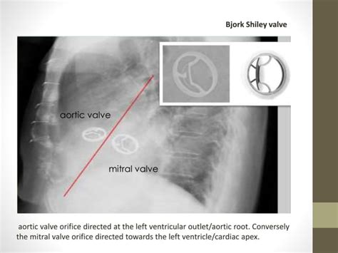 Assessment Of Prosthetic Valve Function Pptx