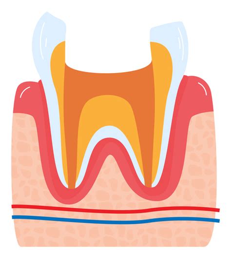 Complete Pulpotomy In Permanent Molars With Irreversible Pulpitis