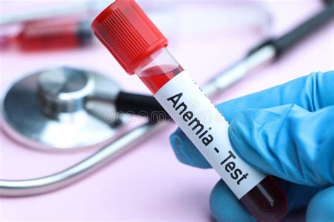 Anemia Test To Look For Abnormalities From Blood Stock Image Image Of
