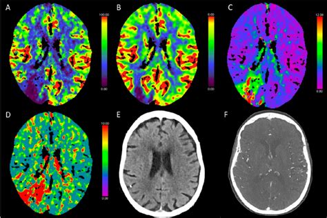 Color Coded Maps Generated From Computed Tomography Perfusion Ctp Of