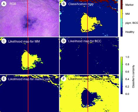 Classification And Likelihood Maps Of A Histologically Confirmed