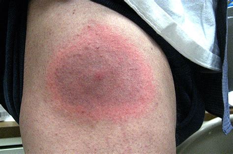 Lyme Disease Journal Of The American Academy Of Dermatology